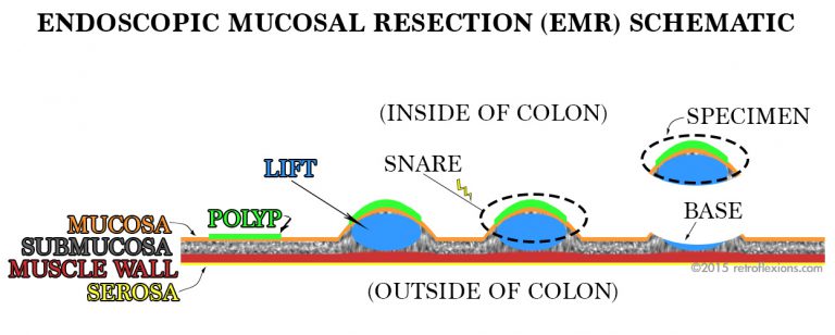 Retroflexions.com » Intro to endoscopic mucosal resection (EMR).